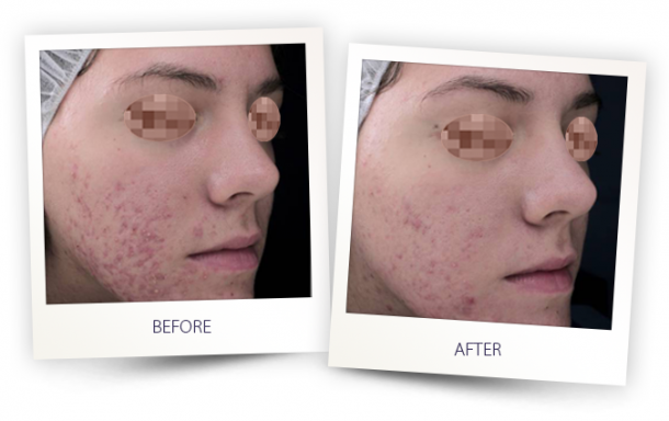 Active Acne Treatments | Hair & Skin